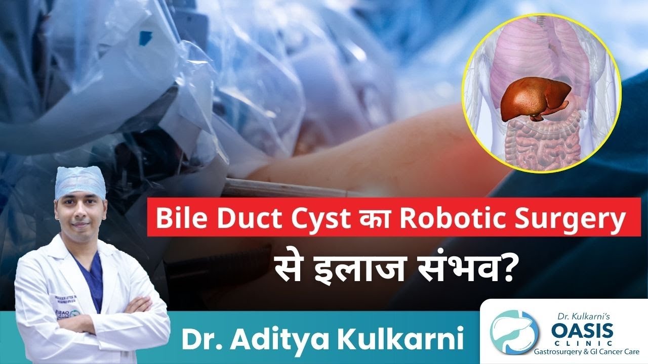 Bile Duct Cyst का Robotic Surgery से इलाज संभव? | Robotic surgery for ...