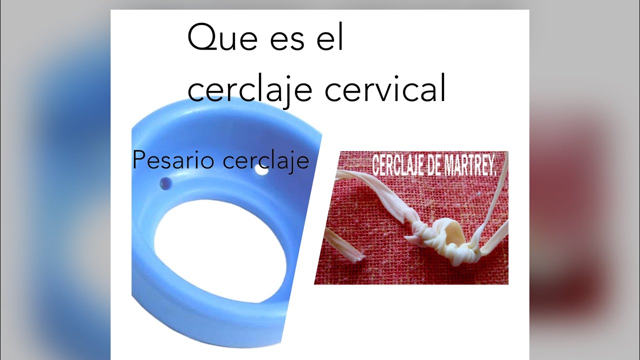 Que es el cerclaje cervical y para que es - YouTube