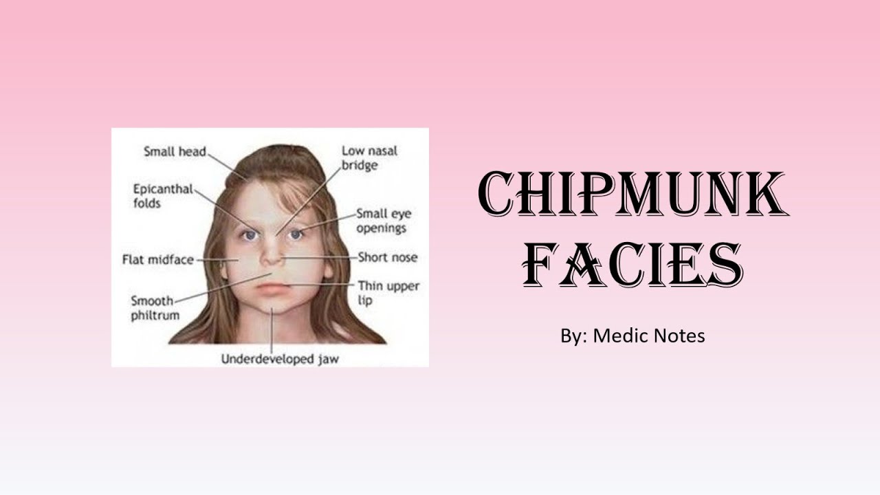 Chipmunk facies - beta thalassemia, parotid gland enlargement ...