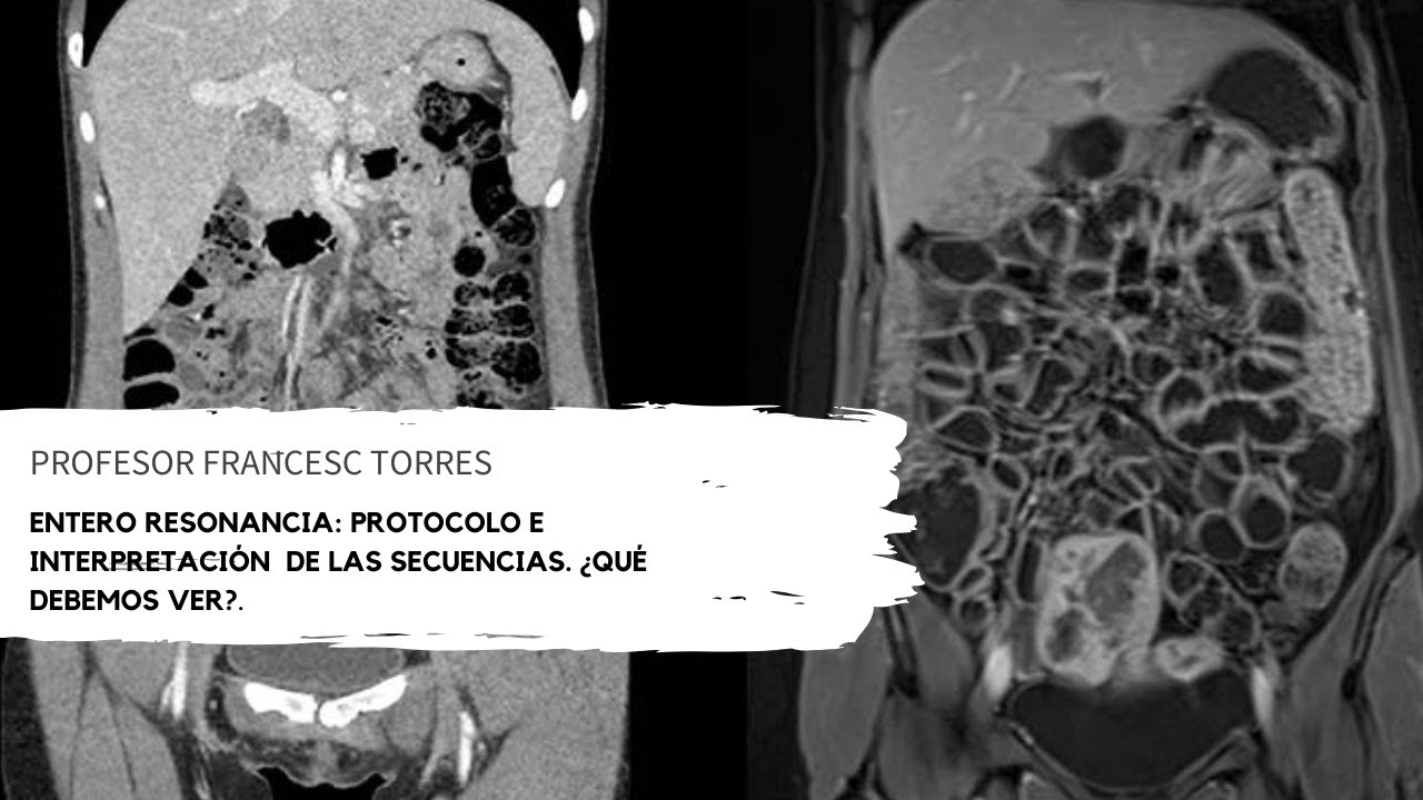 Entero Resonancia :Protocolo e interpretación de las secuencias. ¿Qué ...