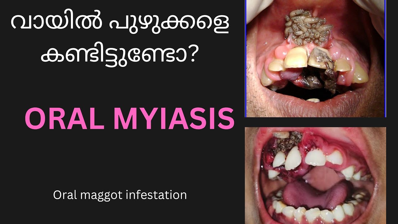 Oral myiasis ( rare case) വായിൽ പുഴുക്കൾ വരുമോ? - YouTube
