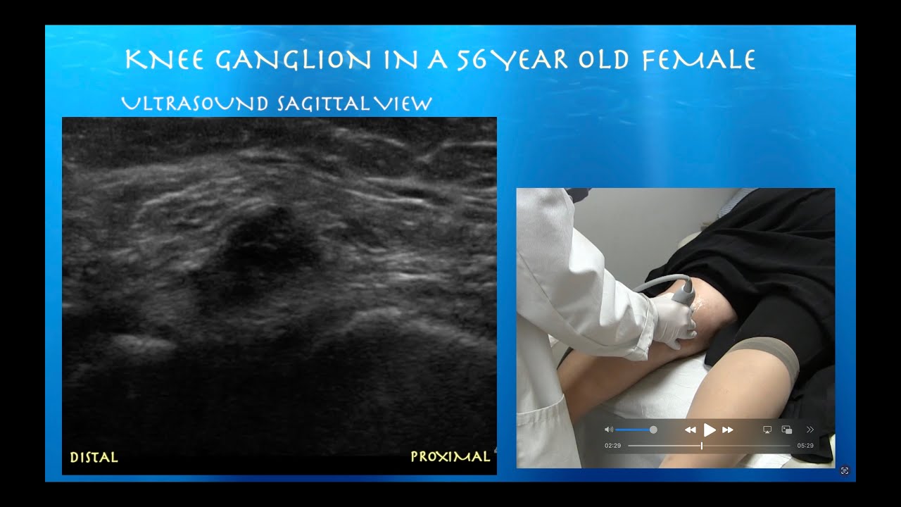 Ultrasound of Knee Ganglion at the Semimembranosus Tendon by ...