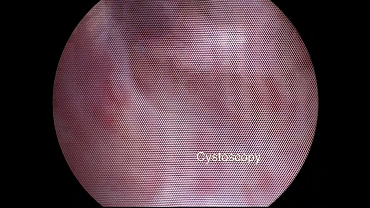 AUA2018 V01-01 Robotic Posterior Urethroplasty for Radiation Induced ...
