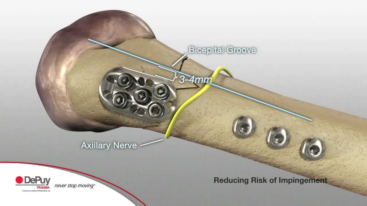 SHOULDER NAIL PLATE - YouTube