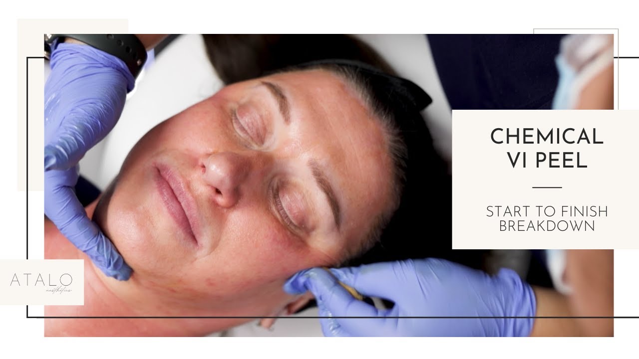 Vi Peel Chemical Peel I Breakdown & Application - YouTube