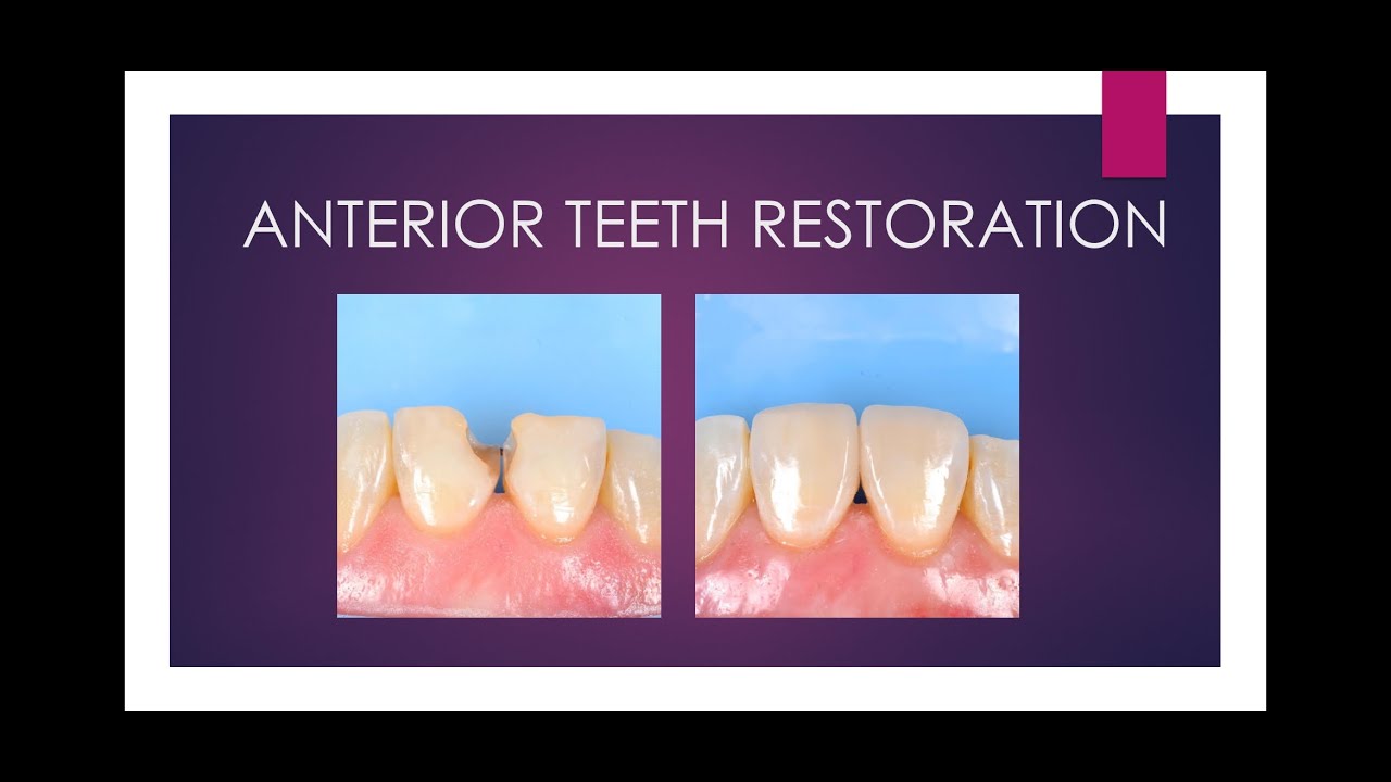 Anterior teeth restoration ♠️ - YouTube