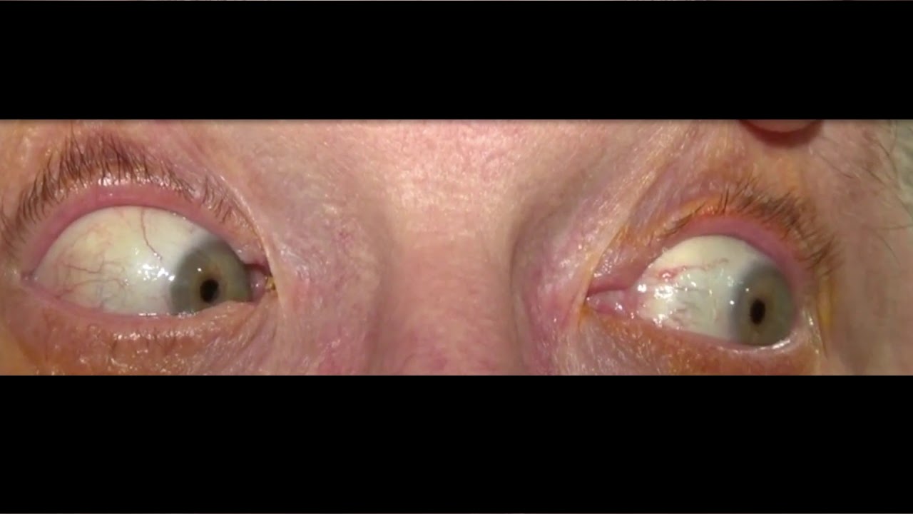 RS Supranuclear Ocular Motor Pathways Part 5 - Vestibuloocular Reflex ...