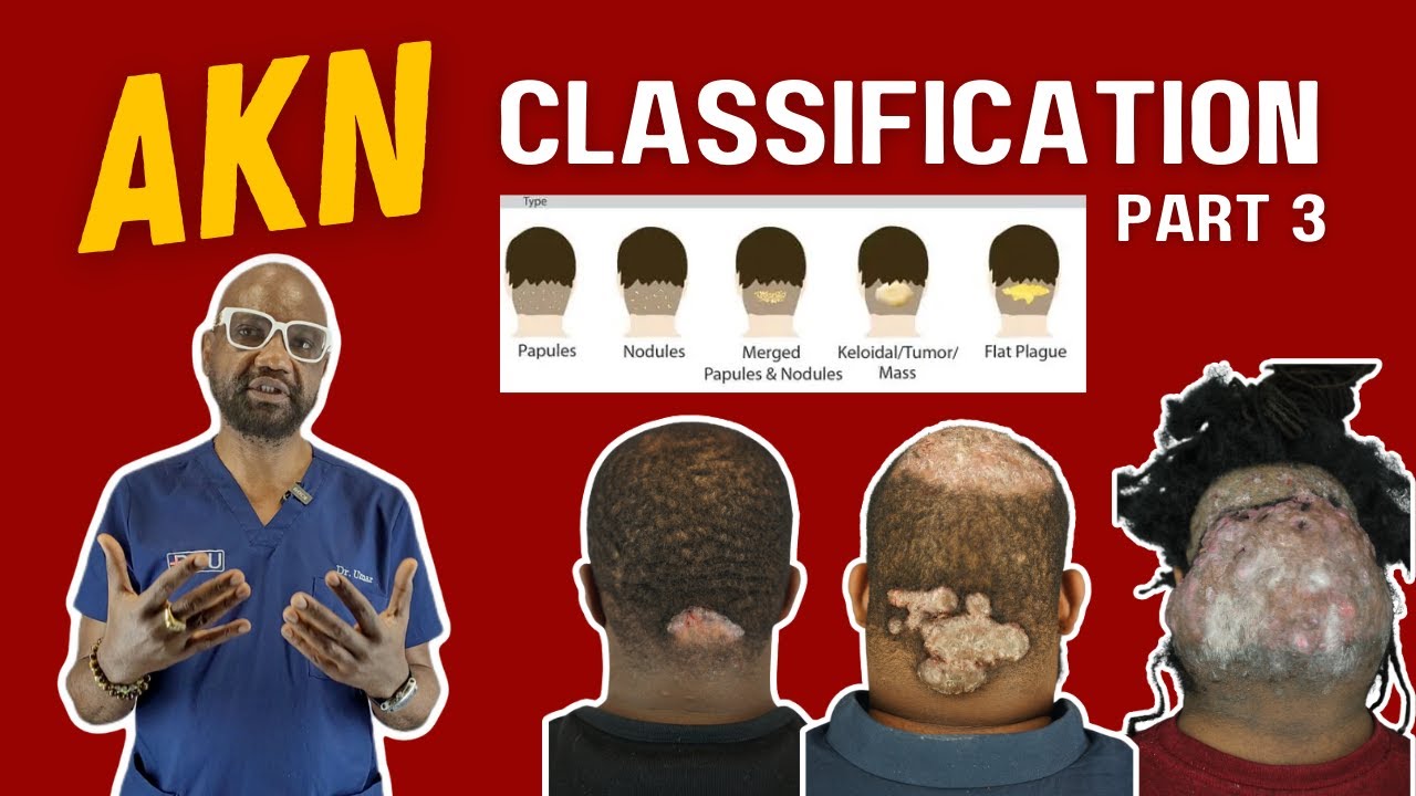 Acne Keloidalis Nuchae (AKN) Classification Part 3 - Dr. U - YouTube