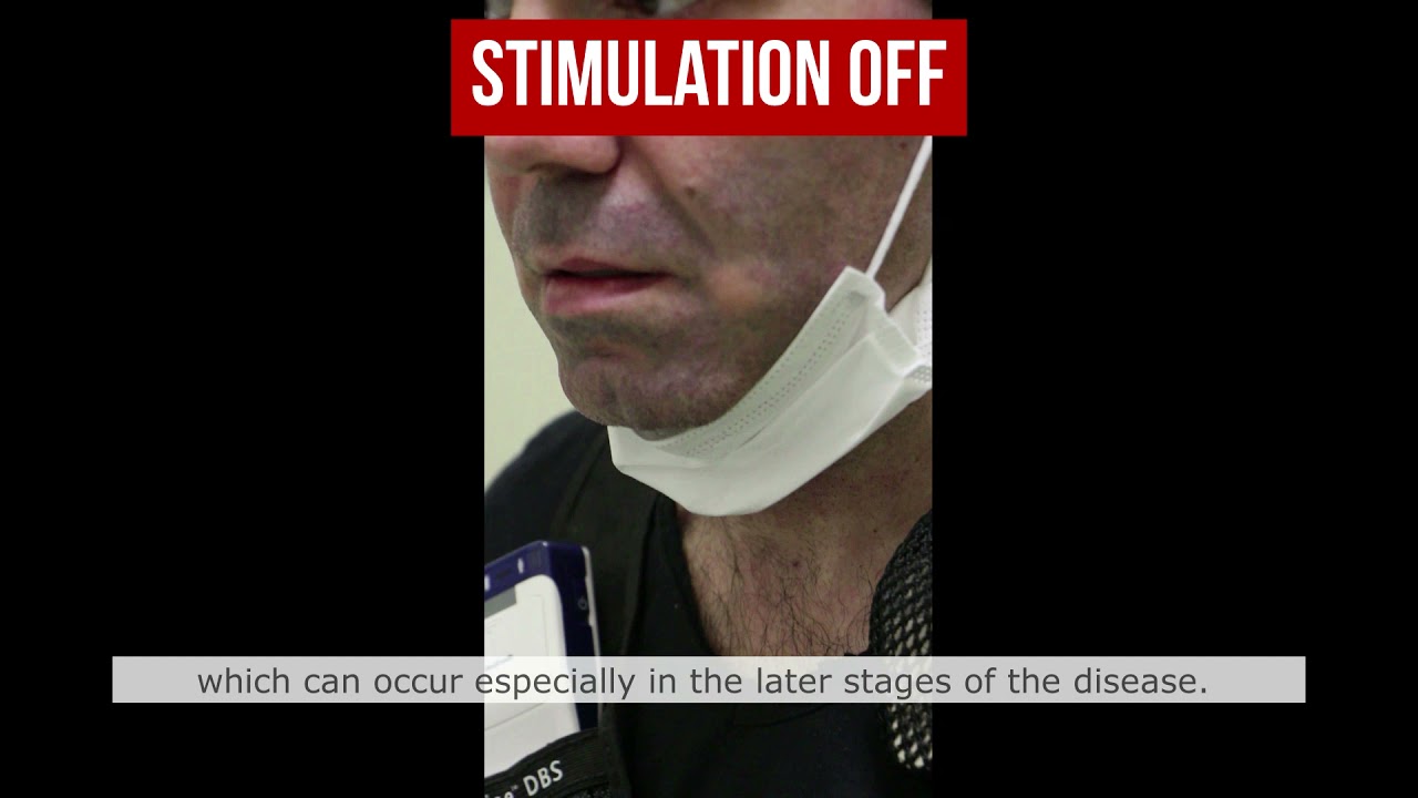 Chin tremors can indicate Parkinson's Disease can be alleviated by Deep ...