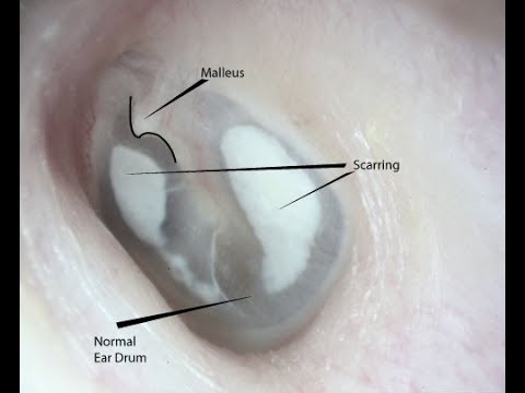 Eardrum regeneration membrane repair - Healthy_of_Ear - YouTube