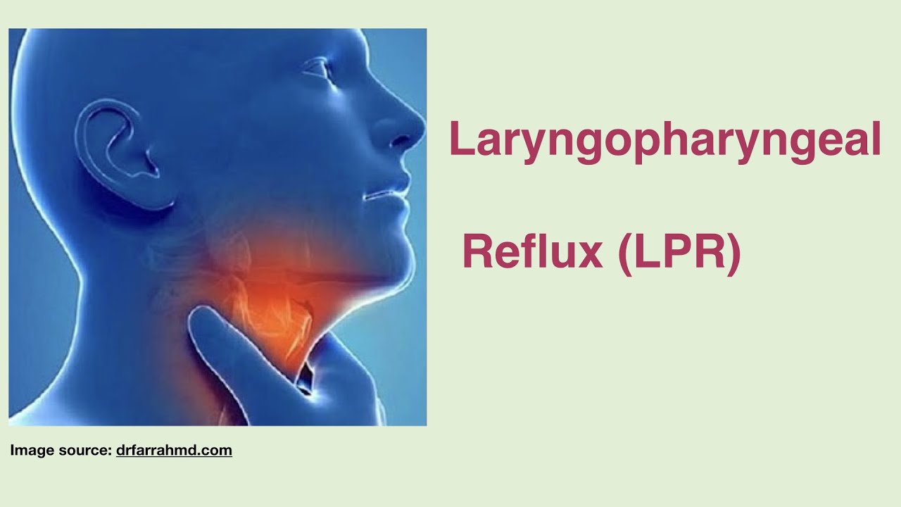 Laryngopharyngeal reflux, another type of acid reflux. - YouTube