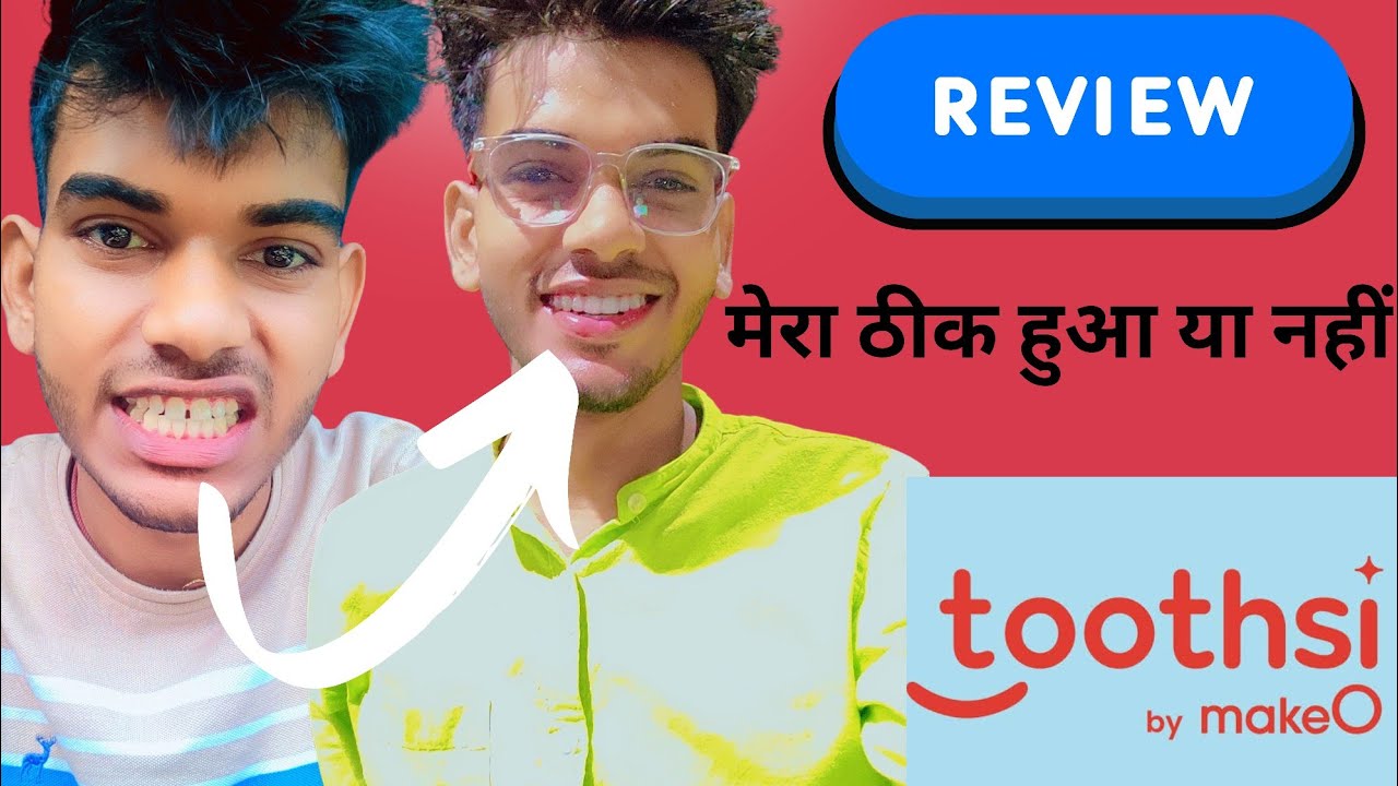 Toothsi aligners Full Honest Review in details , 8 months experience ...