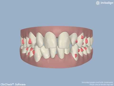 Invisalign - ClinCheck Simulation - Front (First Treatment Plan ...