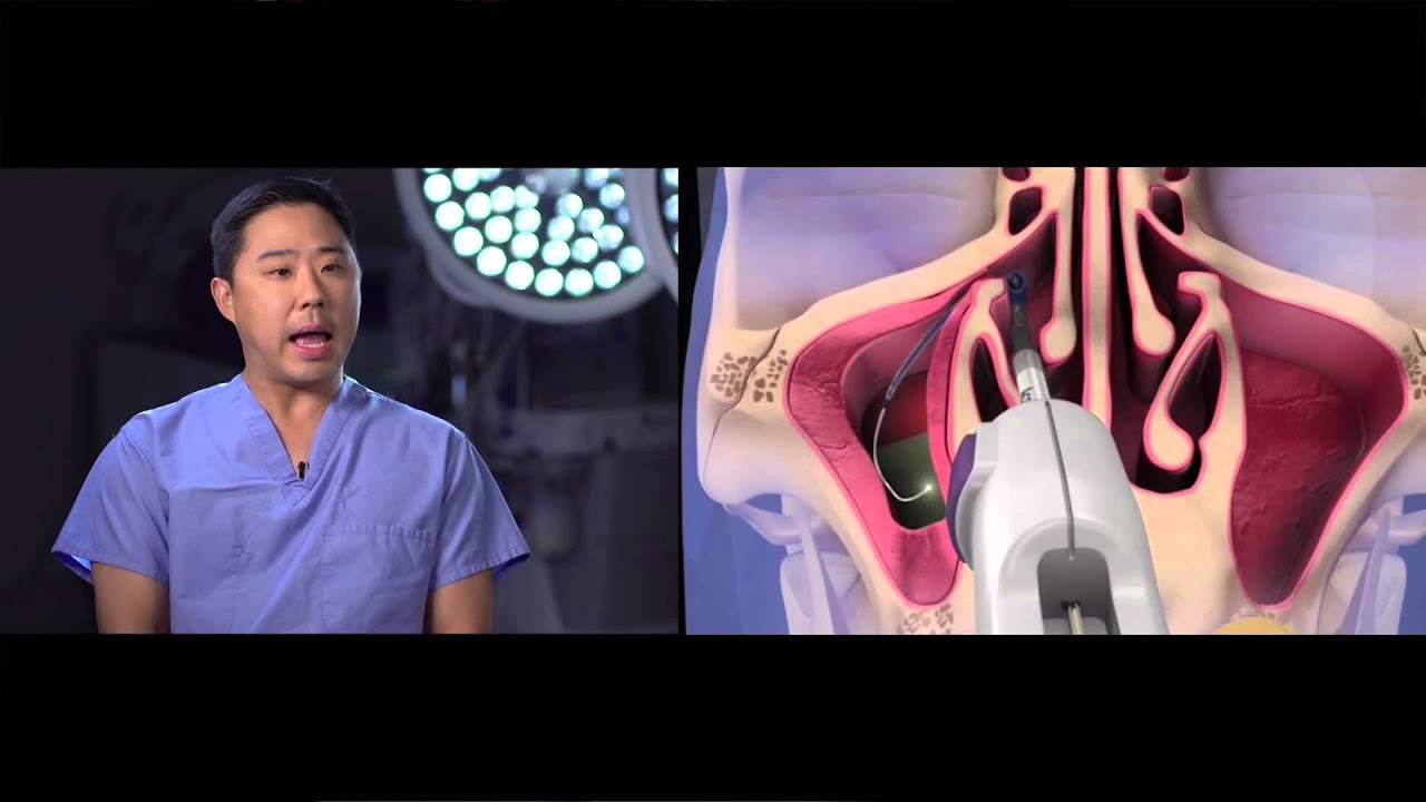 Balloon Sinuplasty In Office Procedure - YouTube