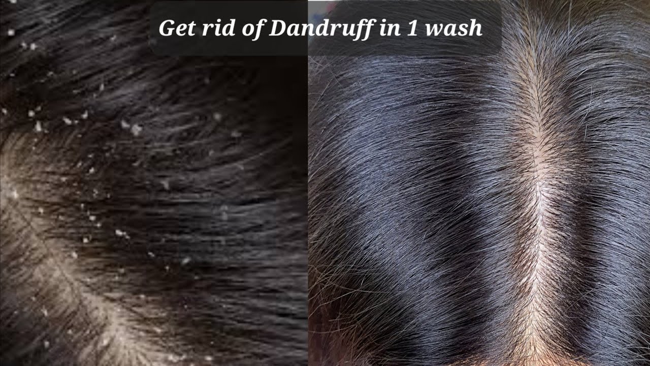With proof How to get rid of dandruff🤔|Home remedies for dandruff👌|How ...