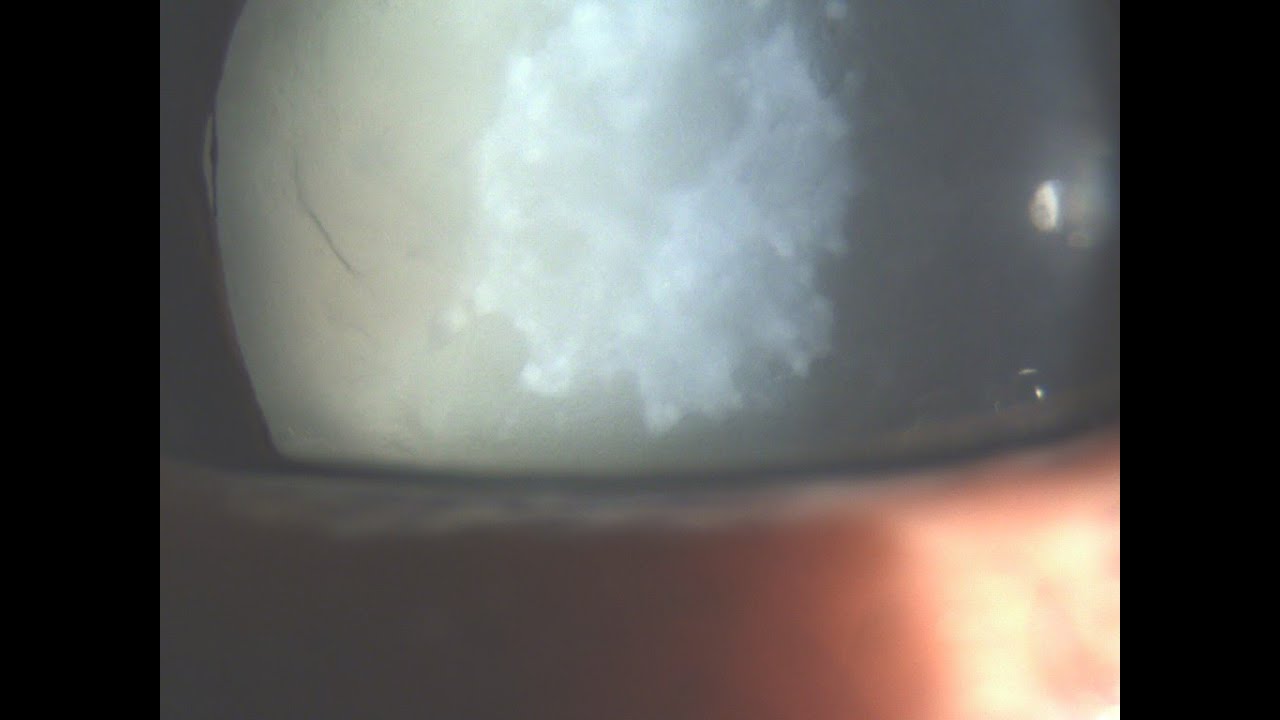 white cataract(thick ASC) surgery, phaco chop, alcon clareon lens - YouTube