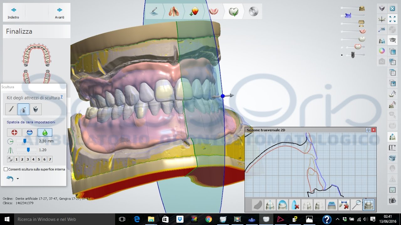 Digital workflow for removable full dentures - YouTube