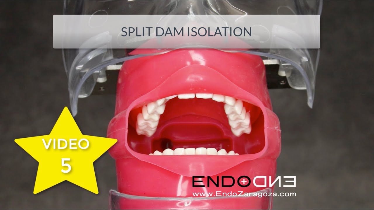 SPLIT DAM ISOLATION TECHNIQUE. In endodontic or restorative procedures to access interproximal ...