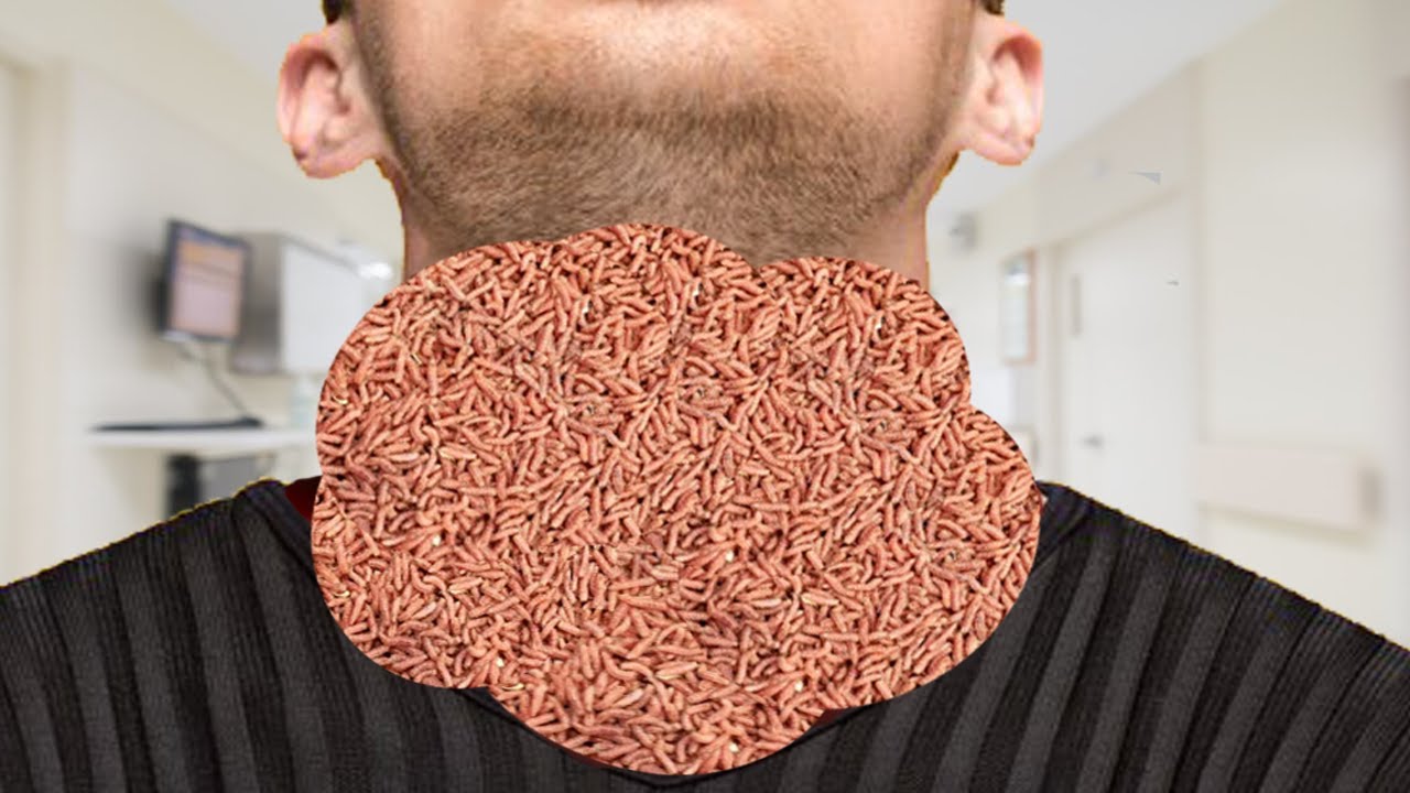 ASMR Remove Big Acne & Worm Infected neck | Deep Cleaning Animation ...