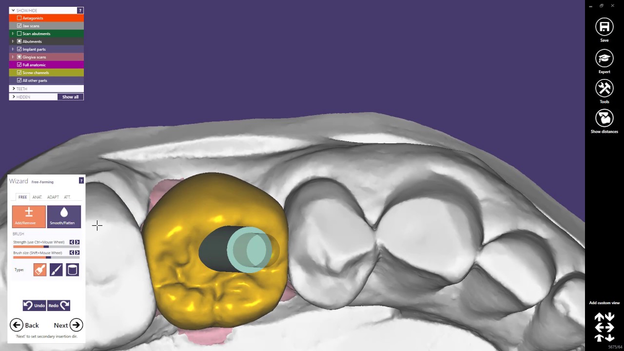 straumann abutment - YouTube