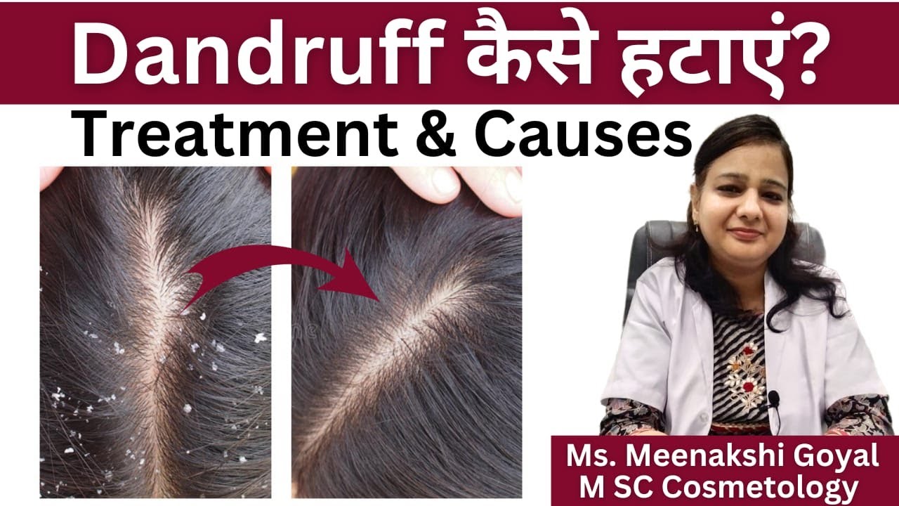 Dandruff kaise hataye | Dandruff Causes and Treatment| Dandruff Removal ...