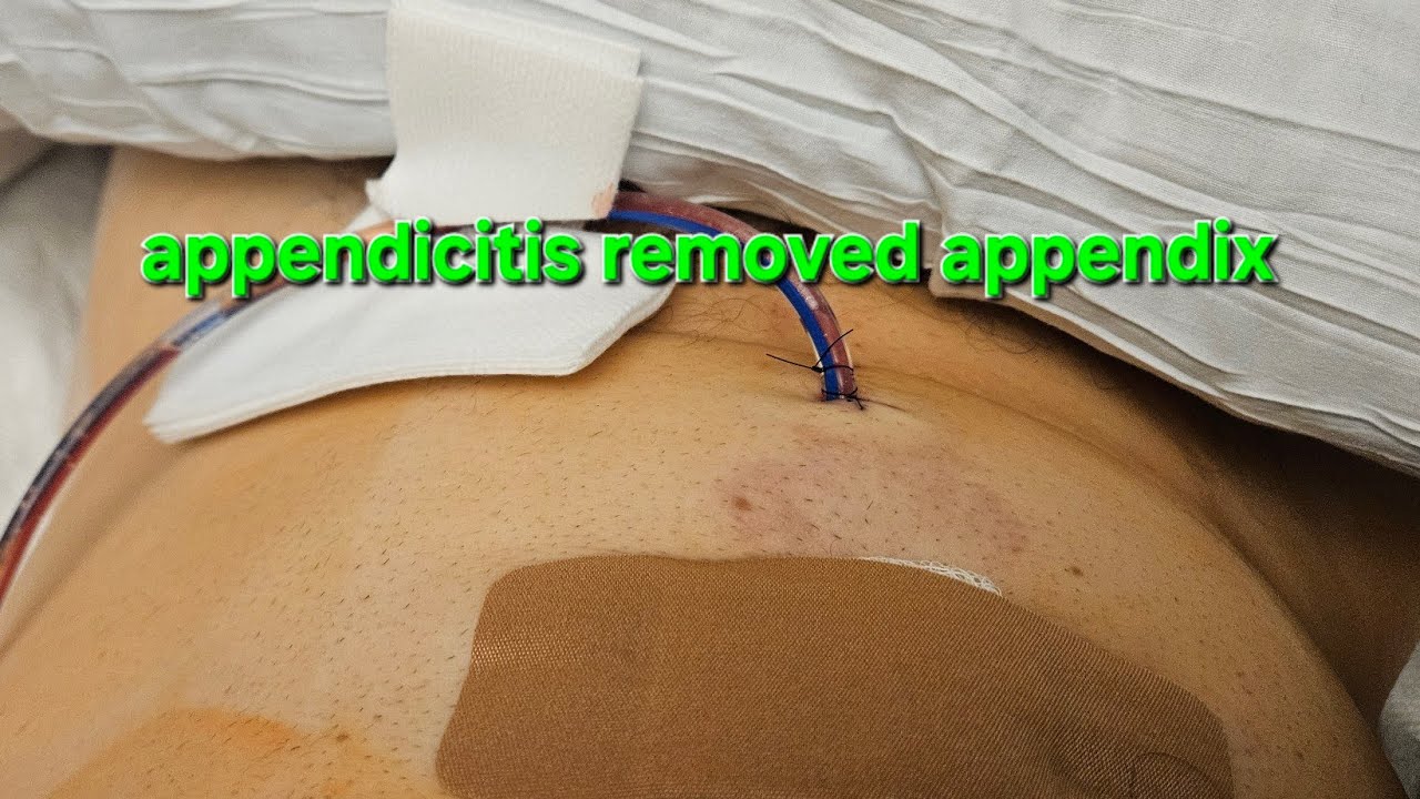 If you were wondering where i was. i had my appendix removed today. was ...