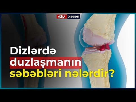Dizlərdə duzlaşmanın səbəbləri nələrdir? - STV XƏBƏR