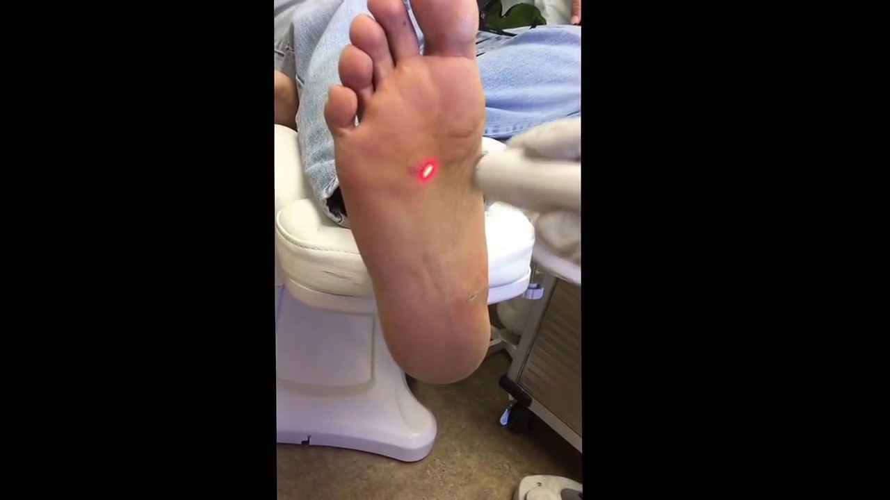 Dr Shoemaker DPM, Roseville, Ca. Cutera laser of scar on sole of foot ...
