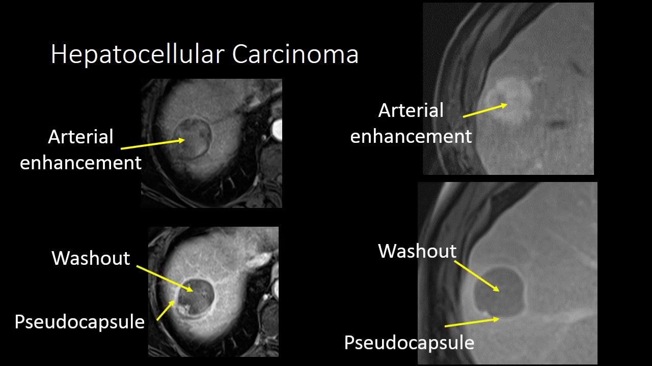 Hepatocellular Carcinoma Mri