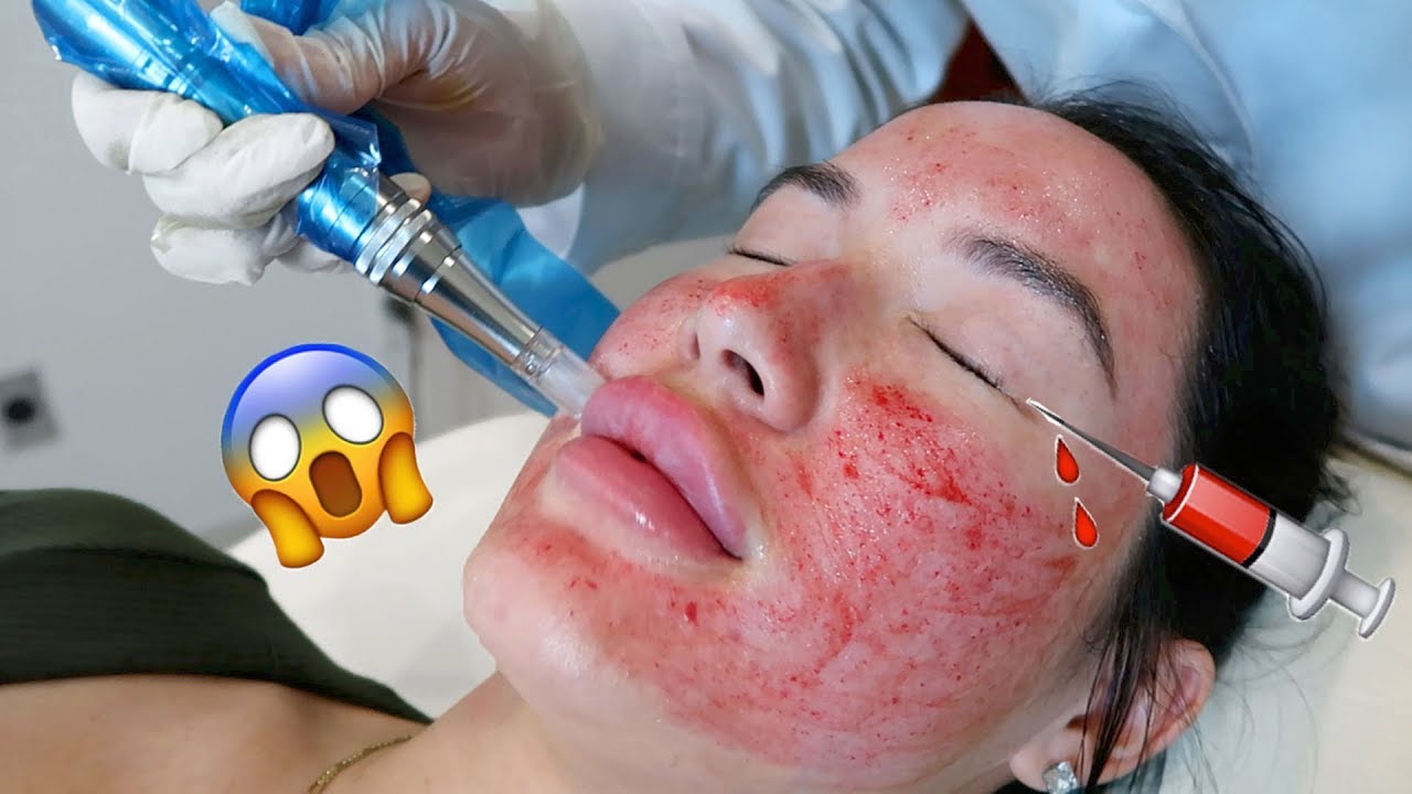 MICRONEEDLING AFTERCARE DAILY UPDATES HOW I CLEARED MY SKIN OF microneedling-aftercare-daily-updates-how-i-cleared-my-skin-of