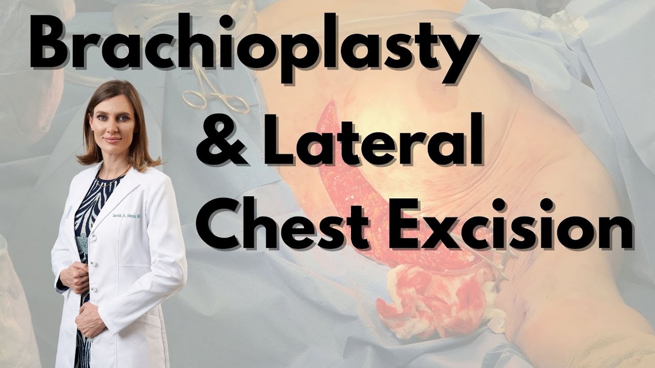 Brachioplasty and Lateral Chest Excision | Dr. Sarah Mess, Baltimore ...