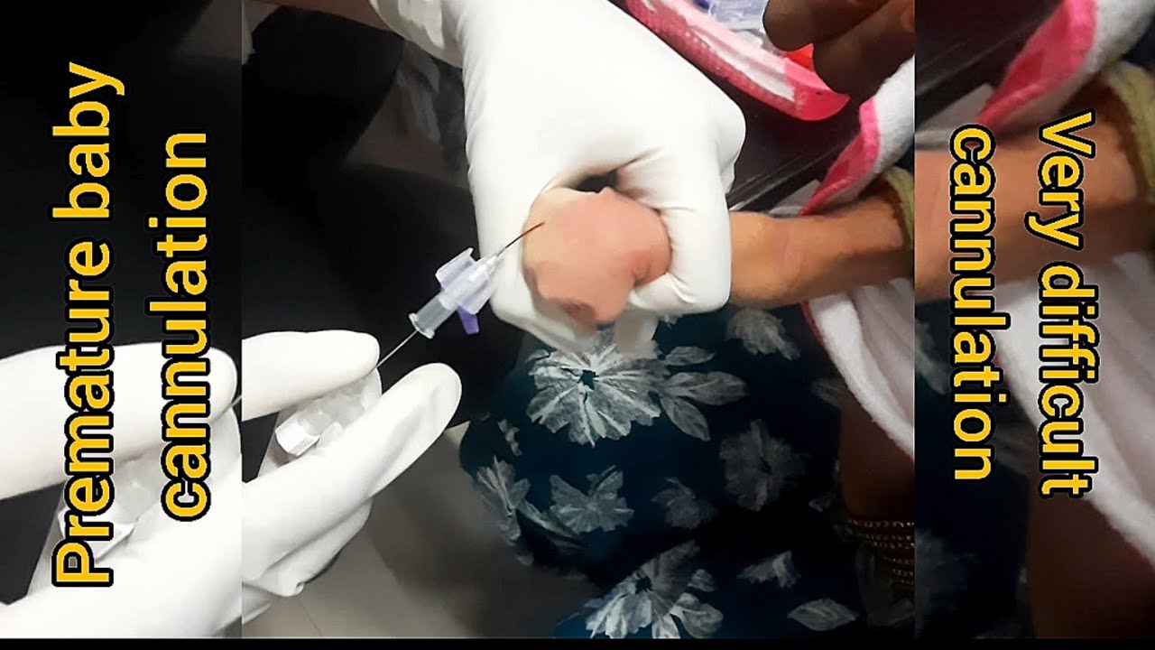 How to insert IV cannula premature newborn baby // pediatric iv ...