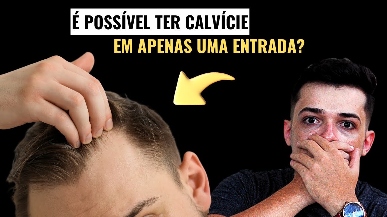 Calvície em uma das Entradas! Recupere Seus Cabelos - YouTube