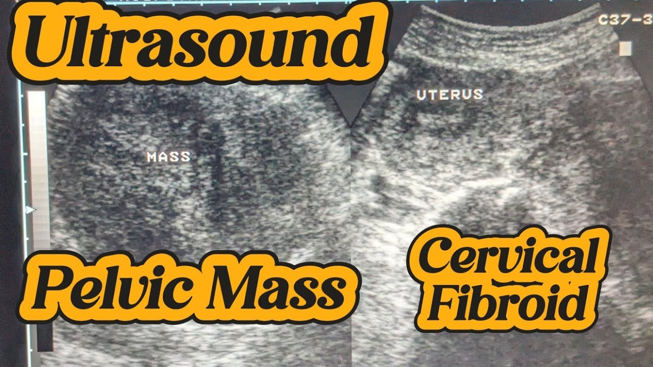 Ultrasound Cervical Fibroid | Pelvic Mass Scan | Urine incontinance ...