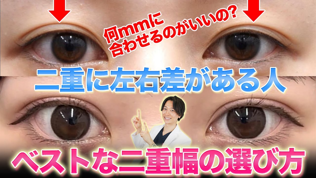 【二重整形】目の開きに左右差がある場合のベストな二重幅の選び方【二重埋没】 Youtube