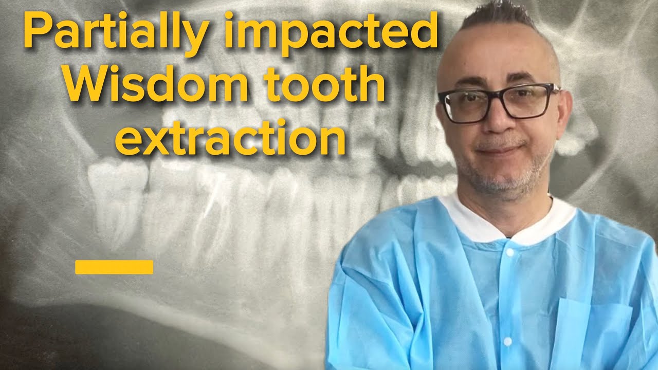 Partially impacted Wisdom Tooth Extraction #wisdomteeth # ...