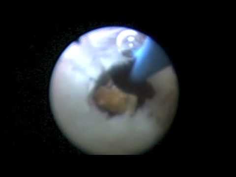 stone in calyceal diverticulum by RIRS - YouTube