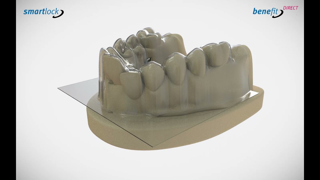 PSM - The Smartlock BENEfit DIRECT Expander - YouTube