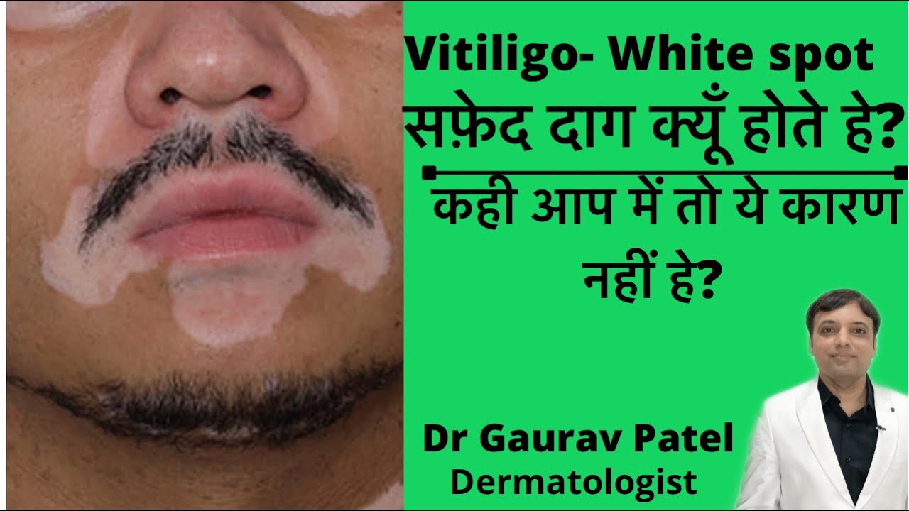 Safed daag kyu hote he? Causes of vitiligo- white spot | Dr Gaurav ...