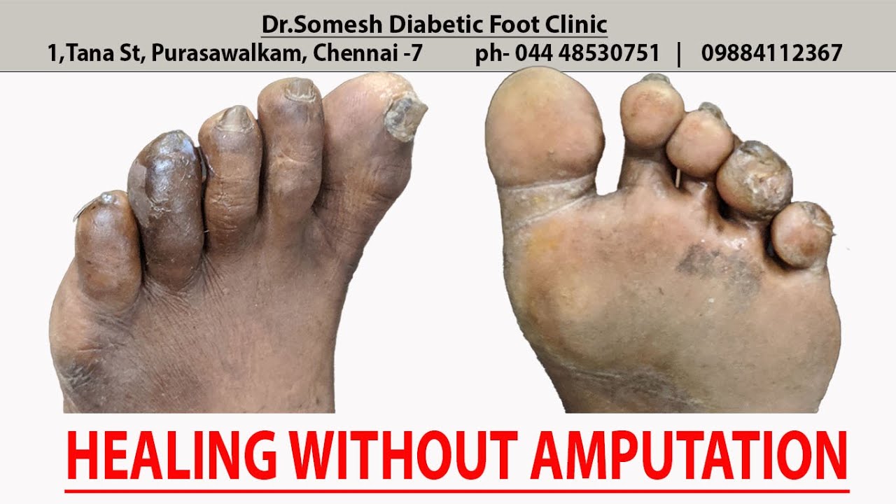 Ring toe infection healing w/o amputation - YouTube