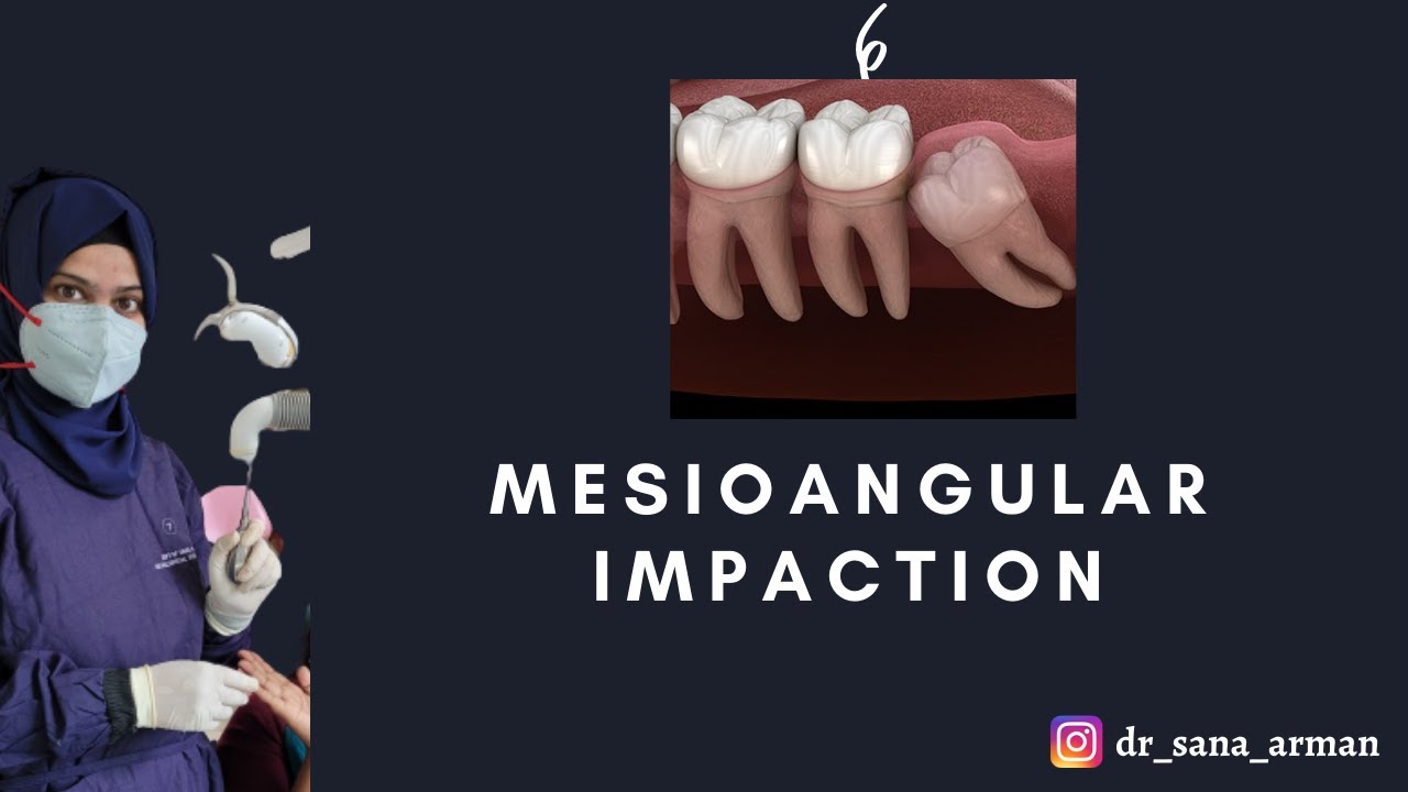 Mesioangular Impacted 38 - Third Molar Extraction / Surgical Removal ...