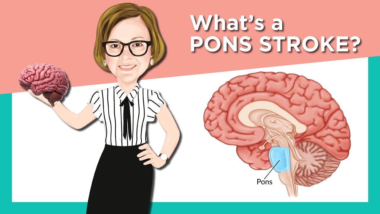 Pons Stroke - YouTube