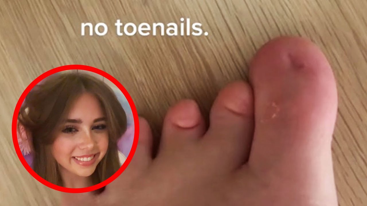 I Was Born Without Toe Nails! 🦶🏼😱 - YouTube