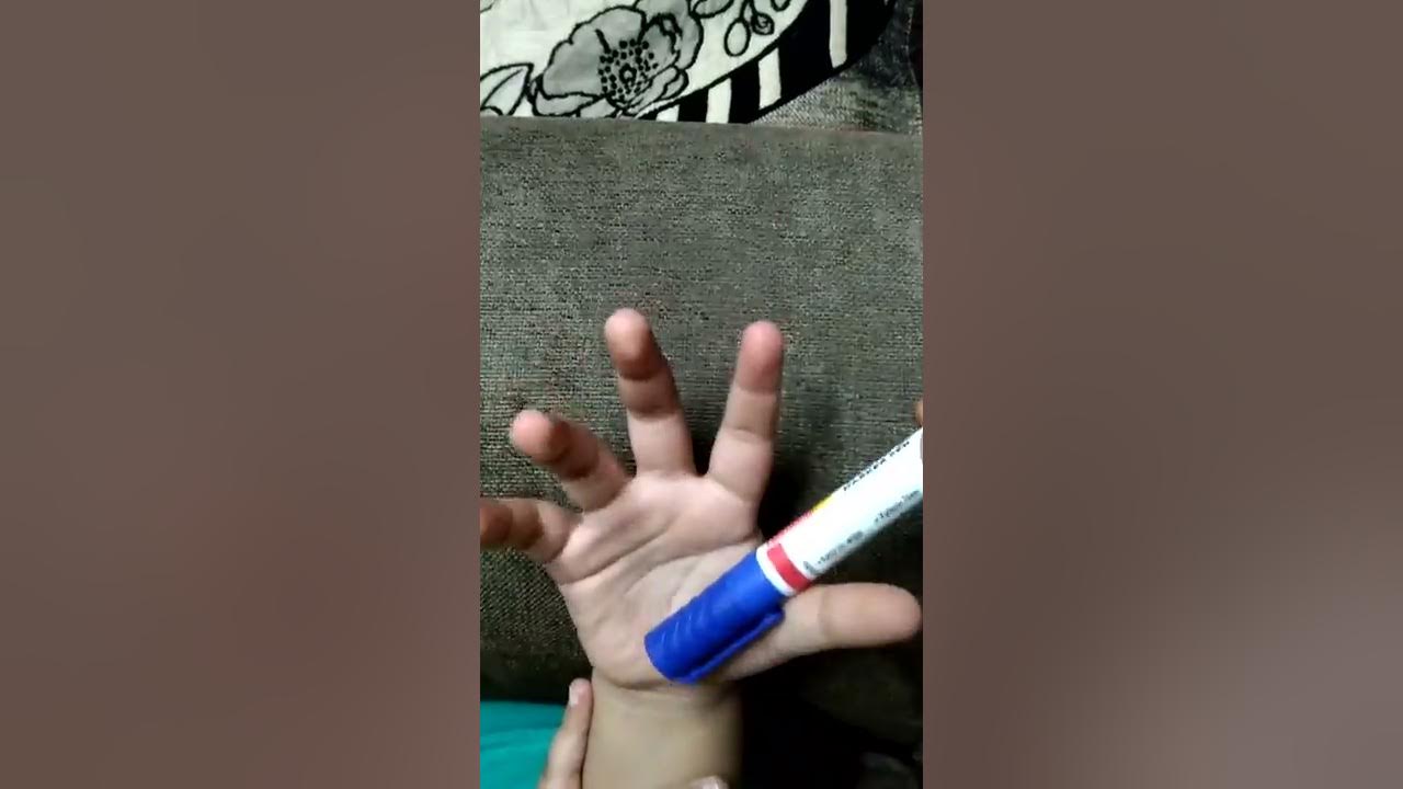 Pen Test | Median Nerve | How to do the pen test | Abductor policis ...