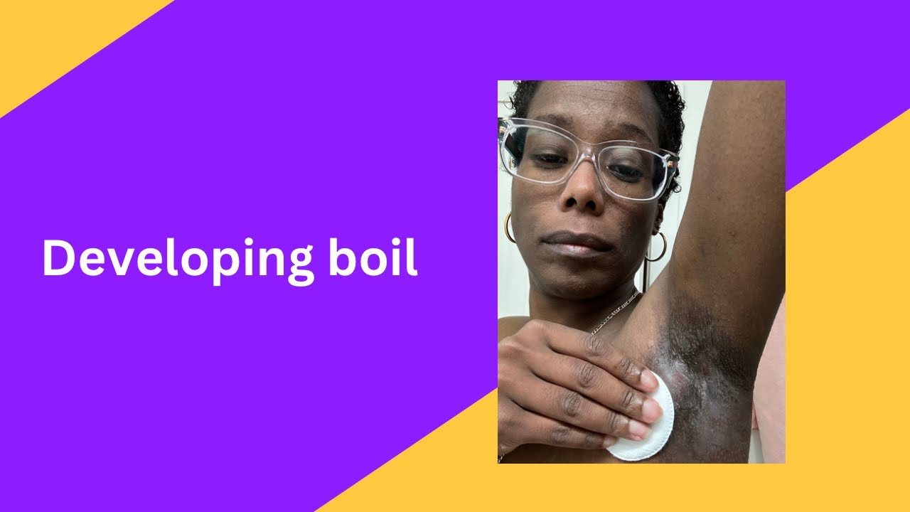 Living and fighting | Developing boil - YouTube