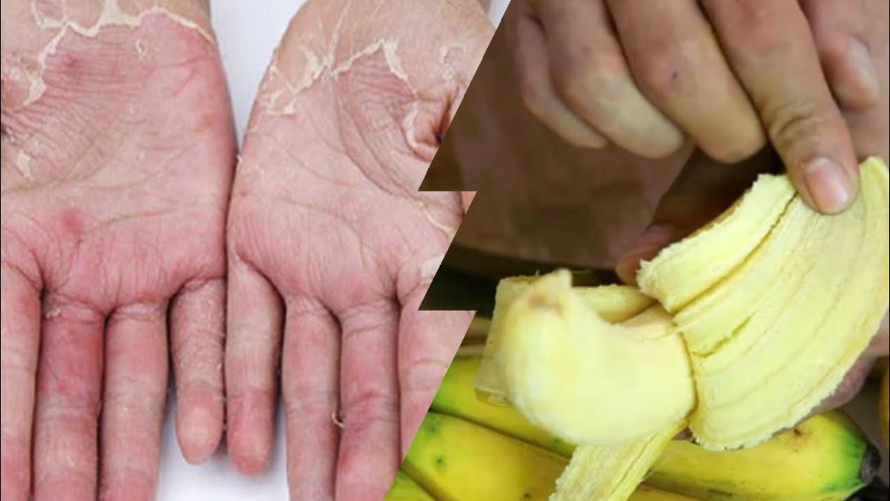 AKO VAM SE KOŽA NA PRSTIMA I DLANOVIMA LJUŠTI,KORISTITE OVAJ PRIRODNI ...