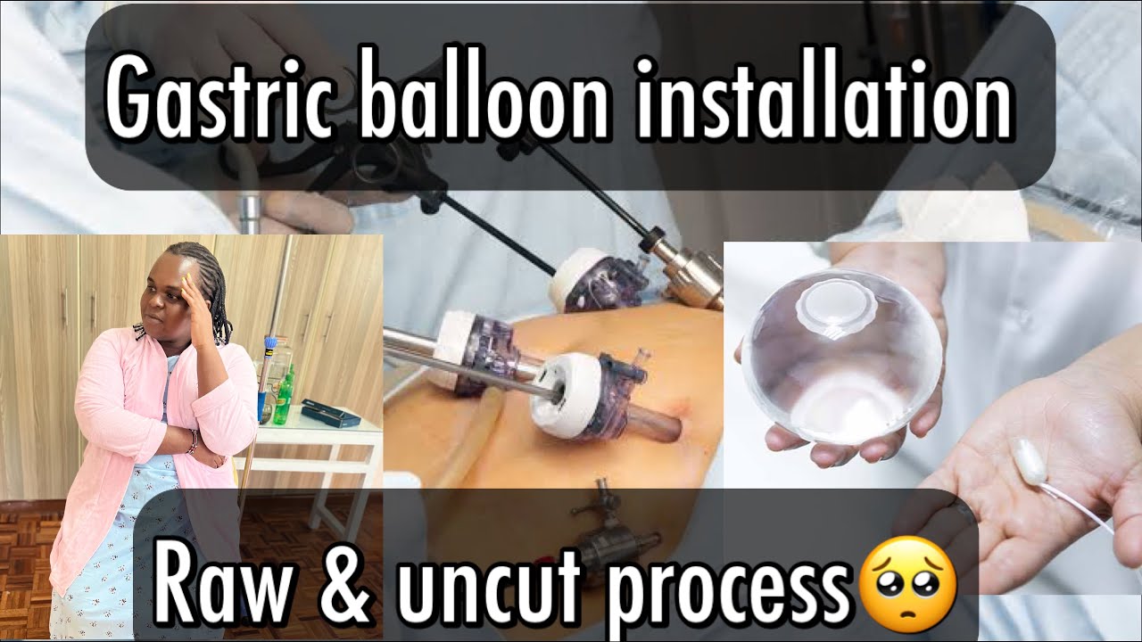 ||RAW AND UNCUT GASTRIC BALLOON INSTALLATION PROCESS 🥰 ️🥰||LIFE WITH ...