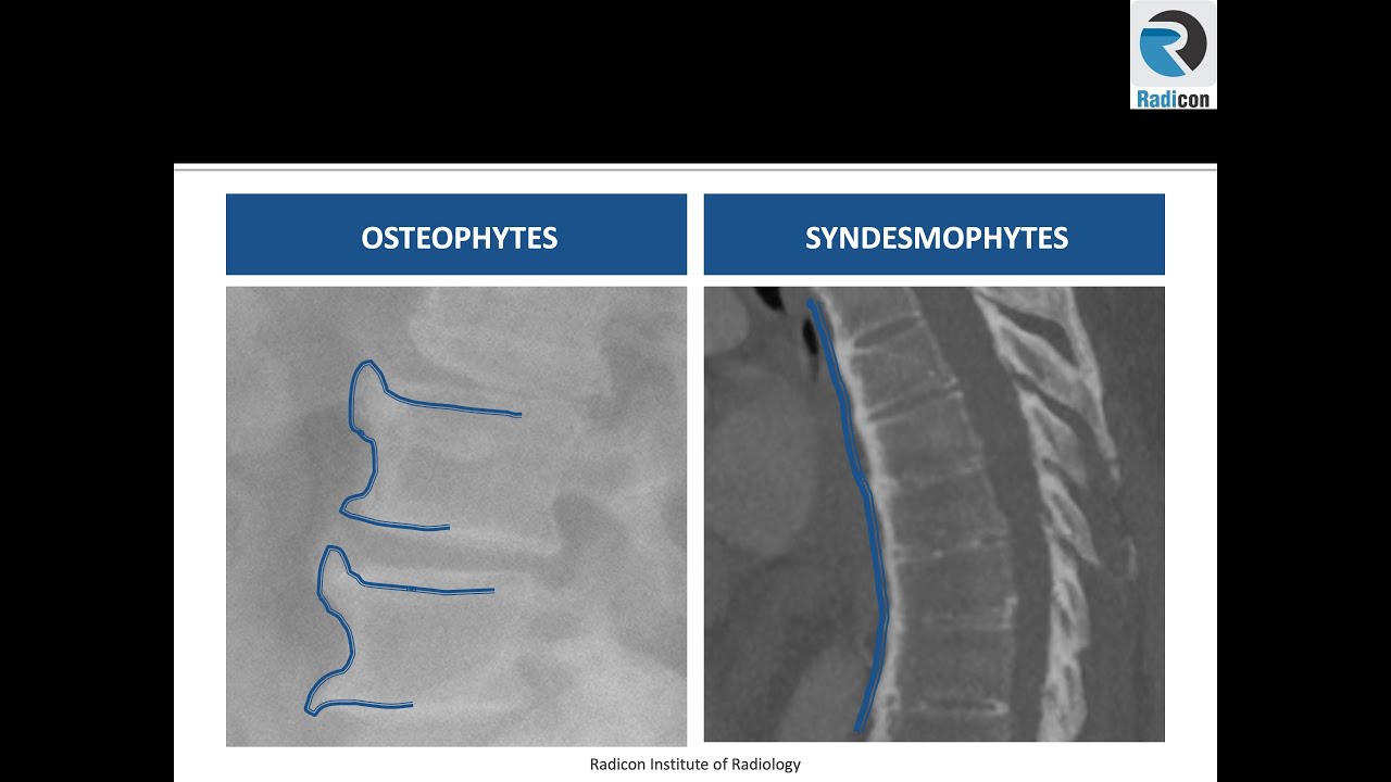 Lumbar Spine MRI Part 6: Phytes and Modic Changes - YouTube