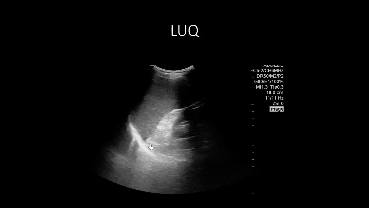 POCUS Cases 9: Abdominal Free Fluid - YouTube
