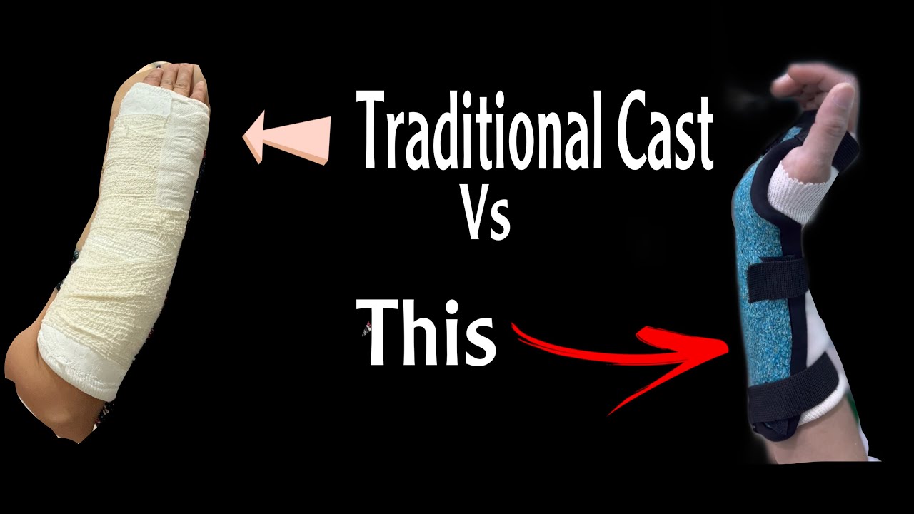 TRADITIONAL CAST VS ADJUSTABLE CAST - YouTube